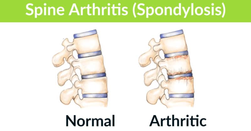 The 5 Most Common Spine Dysfunctions | What to Know | Austin Chiropractor